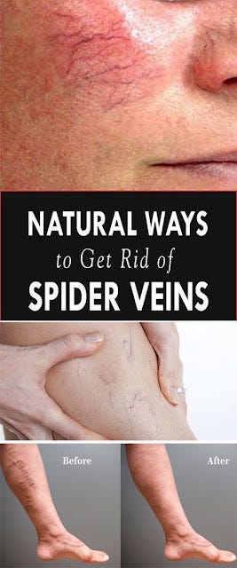 Natural Ways to Get Rid of Spider Veins At Home - Nannie Welch - Medium