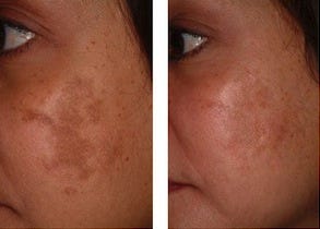 Macchie della pelle: Come Combatterle con la Medicina Estetica | by ...