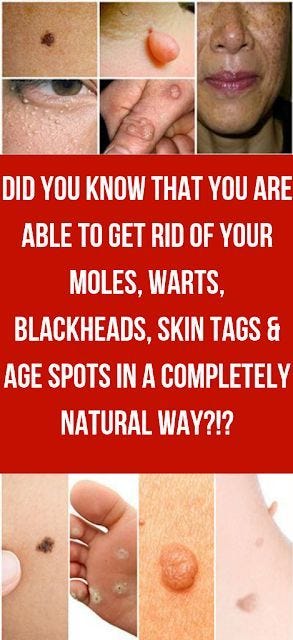 Did You Know that You Are Able to Get Rid of Your Moles, Warts ...