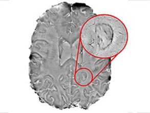 Top 5 Imaging Trends From ECTRIMS 2019 Meeting in Stockholm | by ...