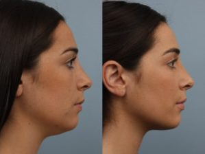 How To Get Rid Of Your Double Chin: Expert Tips And Exercises For ...