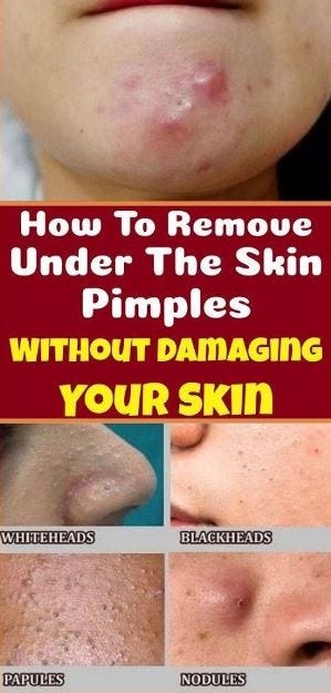 How to remove under the skin pimples without damaging your skin ...