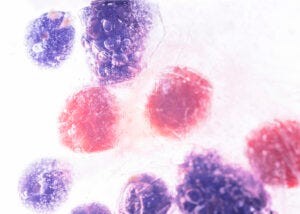 PACRITINIB FOR MYELOFIBROSIS: A BREAKTHROUGH TREATMENT OPTION | by ...