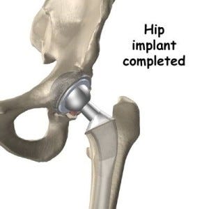 Hip Replacement Procedures. Hip Replacement Surgery | by Christy Smith ...