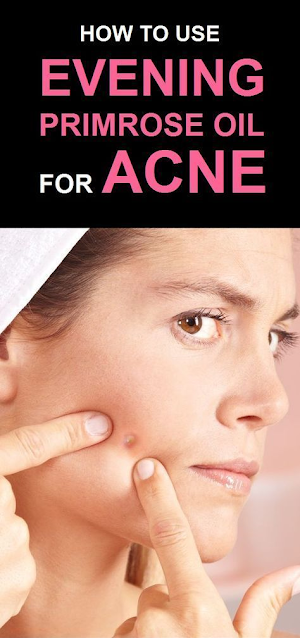 How to get rid of acne fast with evening primrose oil - Isobel roberts ...
