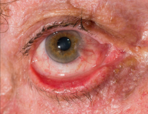 Navigating Eyelid Disorders: A Closer Look at Entropia and Ectropia ...