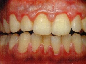 Do your gums bleed?. The most common dental disease seen in… | by Amit ...