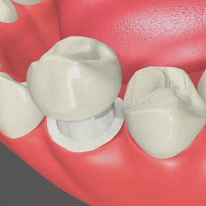 What’s the best kind of crown for your tooth? | by Jared R. Anderson ...