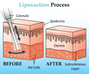 How Is Liposuction Done?. Before the procedure starts, you will… | by ...