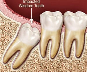 Impacted teeth. Those teeth which fail to erupt into… | by Oracle32 ...