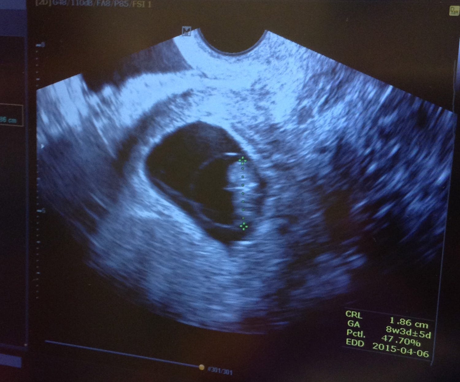 41 Weeks Pregnant Ultrasound