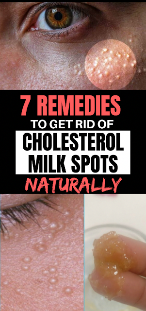 7 Remedies To Get Rid Of Cholesterol Milk Spots Naturally ...