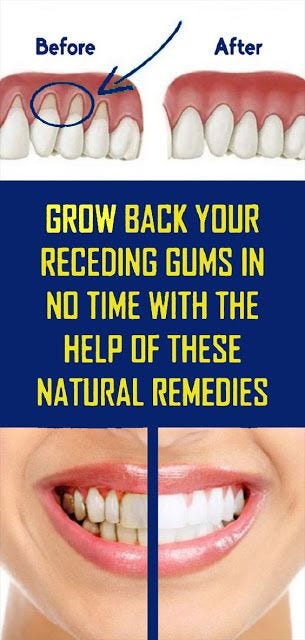 Grow Back Your Receding Gums With The Help Of These Natural Remedies ...
