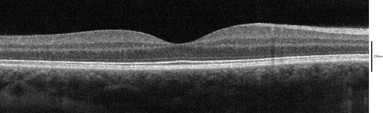 Normal Macular Oct