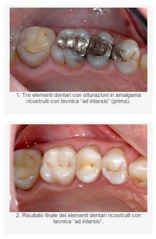 Intarsio Dentale: Il Restauro Estetico | by Paolo Maria Luino | Beauty ...