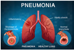 AI In Medical Imaging Project-Pneumonia Detection Using CNN (Part-1) | by Shweta Kumar | Medium