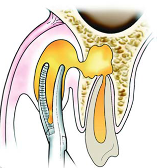 Incision and drainage of abscesses | by Oracle32 | Oracle32 | Medium