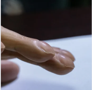 You Might Have Cancer If Your Nails Look Like These. | by Malik Farrukh Awan | Medium