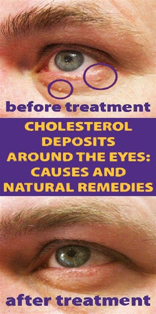 How to Remove the Cholesterol Deposits Around Your Eyes - Nannie Welch ...