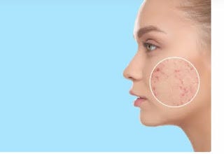 Acne on one side of your face? 4 everyday things to watch out! by ...