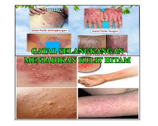 Jenis Obat Gatal Selangkangan bersisik di Apotik terdekat | by ...