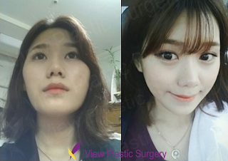 NATURAL V-LINE + REDUKSI TULANG PIPI + IMPLAN DAHI | by Viewquestion ...