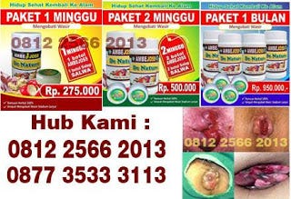 cara tradisional menghilangkan benjolan bengkak di lubang dubur mirip ...