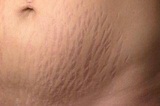 Apakah Stretch Mark yang Sudah Lama Bisa Hilang? | by Hasan Basri | Medium