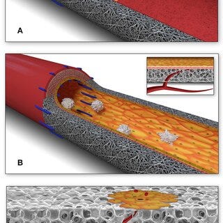 The Rising Demand for Man-made Vascular Grafts in North America | by ...