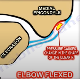 Why Excessive Use of a Cell Phone aggravates and can cause Cubital ...