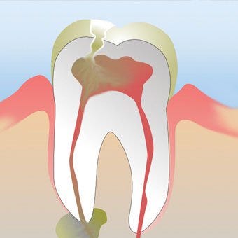 Bleeding after tooth extraction. Bleeding after a tooth extraction is ...