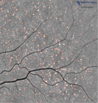Imaging Retinal Amyloid — The Virtual Brain Biopsy | by Alexander Louis ...