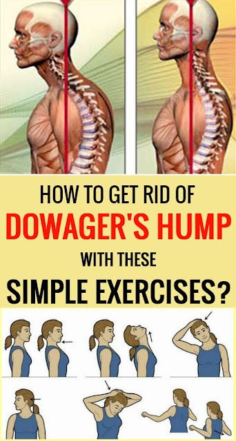 How To Get Rid Of Dowager & Hump With This Simple Exercises | by ...