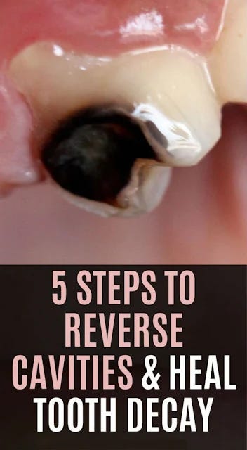 5 Steps For Healing Your Tooth decay And Reverse Cavities - Mary ...