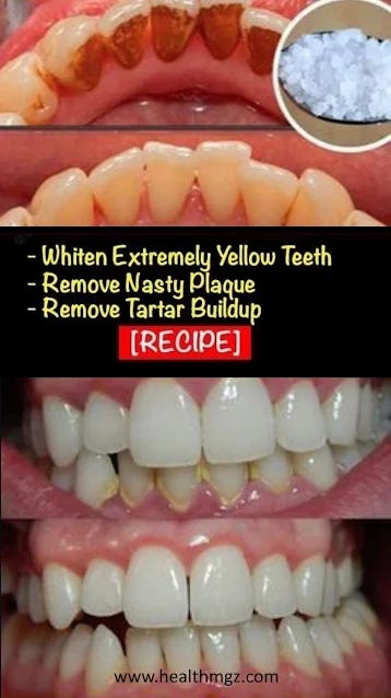 This Can Even Whiten Extremely Yellow Teeth And Remove That Nasty ...