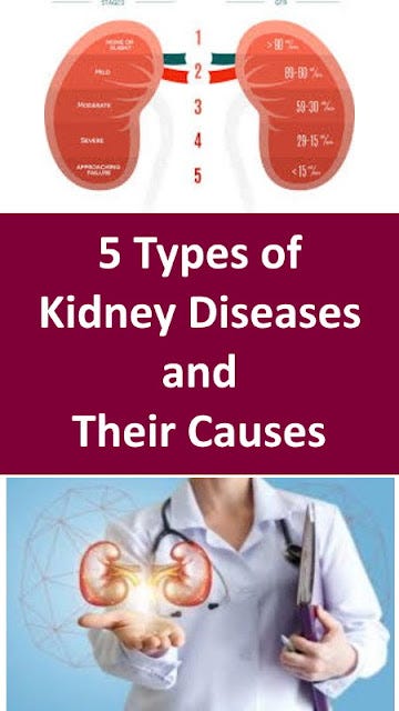 5 Types of Kidney Diseases and Their Causes - Mary odonnell - Medium