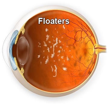 What are the Risks of Eye Floater Treatment? - Dr. Vaidya Eye Hospital ...