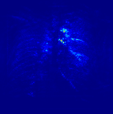 Towards explainable AI for healthcare: Predicting and visualizing age in Chest Radiographs | by ...