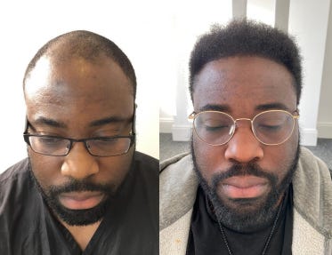 In hair transplantation, two graft kinds are used: micrografts and tiny ...