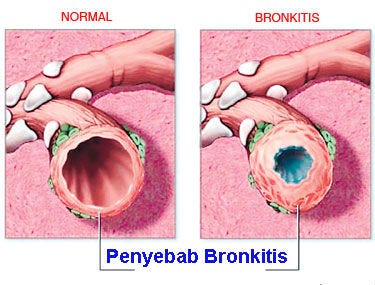 Menyembuhkan Penyakit Bronkitis Menggunakan Bahan Alami | by Agen ...