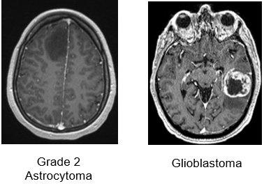 Understanding Astrocytoma Prognosis: What You Need to Know | by ...