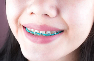 Blue Braces: Your Ultimate Guide to Style, Function & Confidence | by ...