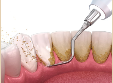 The Significance of Regular Teeth Cleaning | by Thumbs Up Dental ...