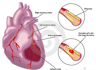 Symptoms, Prevention and Treatment of Myocardial Infarction - Heart ...