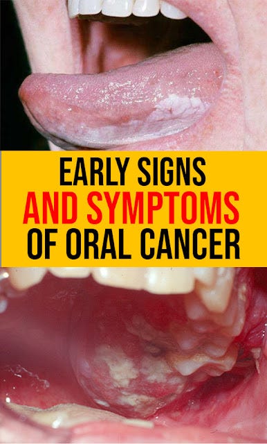 Warning Signs Of Oral Cancer: Are You At Risk? - Marisacaca - Medium