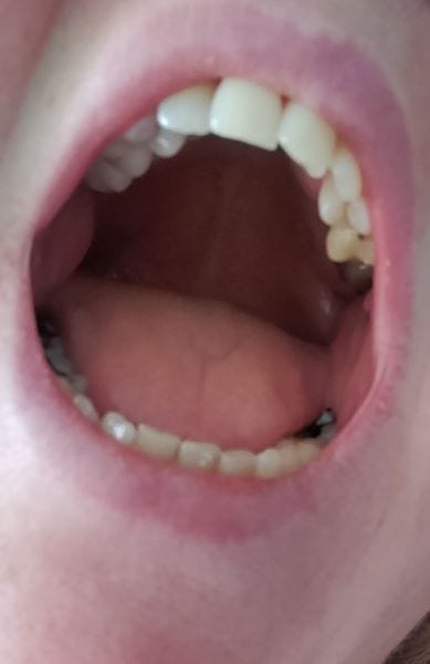 The F****ing dentist !. blamed me for an ill fitting bridge. | by ...