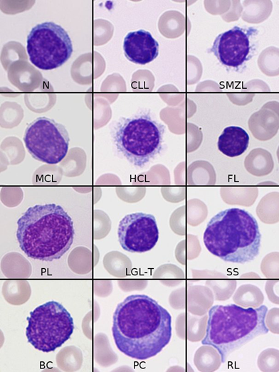 Leukemia Cells With Labels