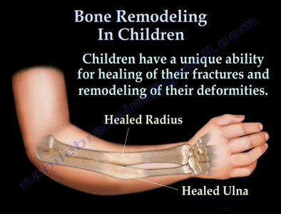 Fractures and Bone Remodeling in Children | by Nabil Ebraheim | Medium