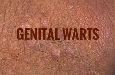 Fordyce Spots Vs Warts: Decoding Skin Concerns | by Bridgette potts ...