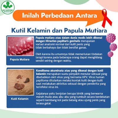 Hilangkan Benjolan Kutil kelamin. KUTIL KELAMIN TAK KUNJUNG SEMBUH ...